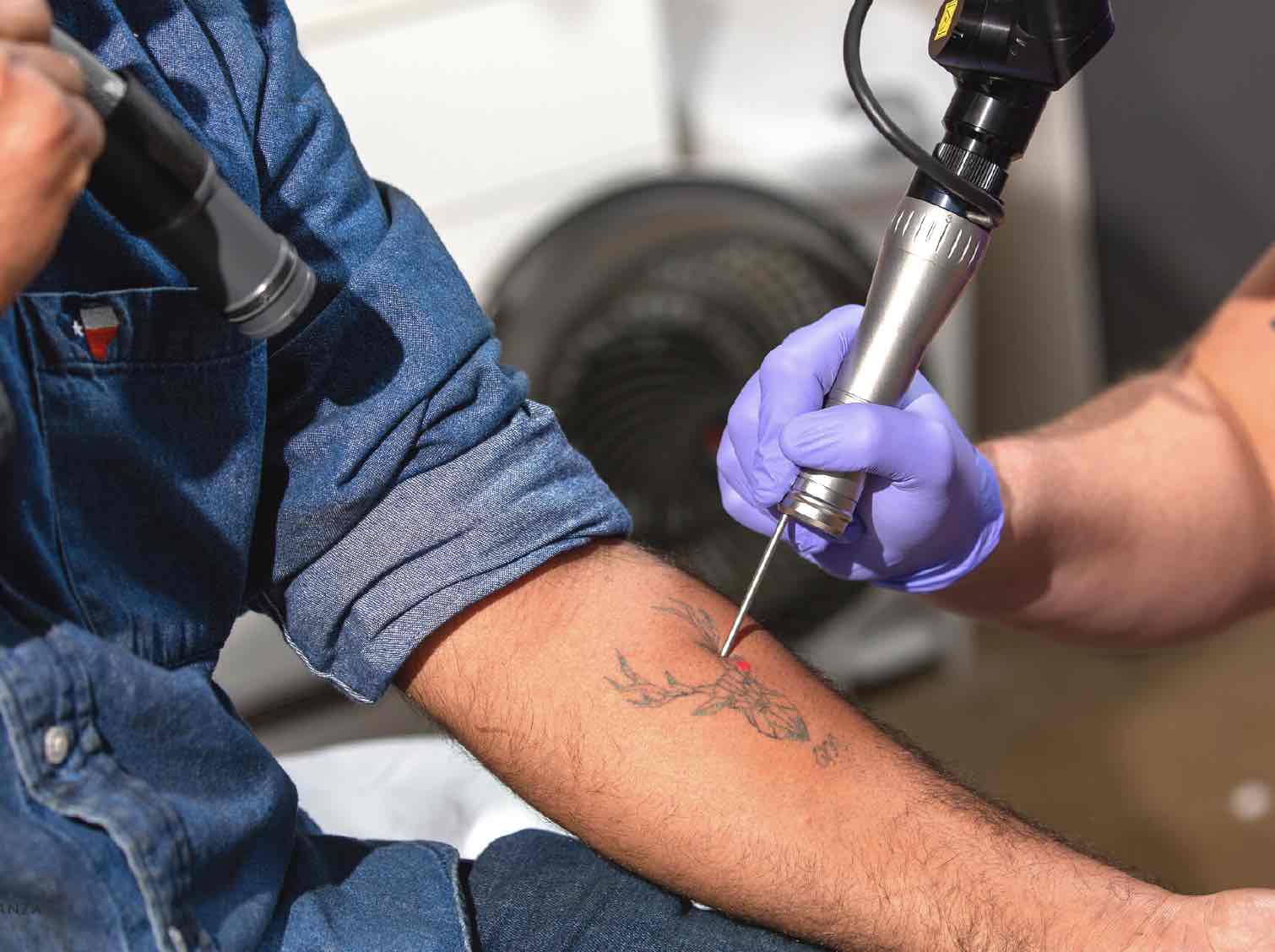 Skin Numbing Methods for Laser Tattoo Removal