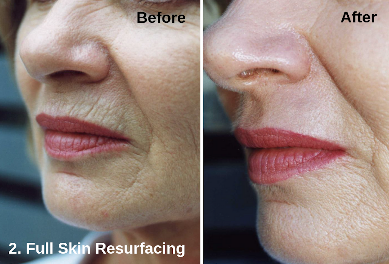 Skin Resurfacing Treatments Using Advanced Aesthetic Laser Equipment