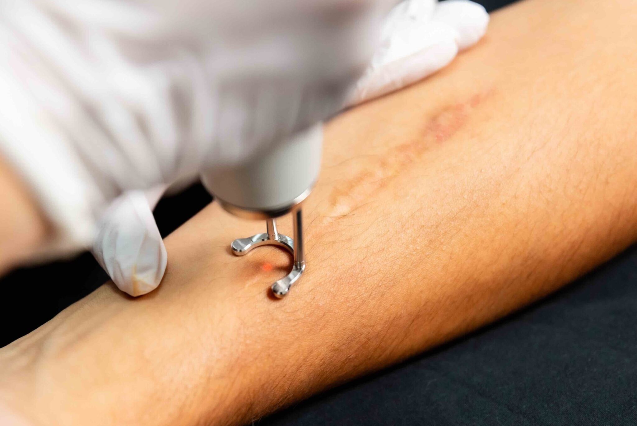 Laser Scar Removal Machines for Clinics & Med Spas | Astanza Laser