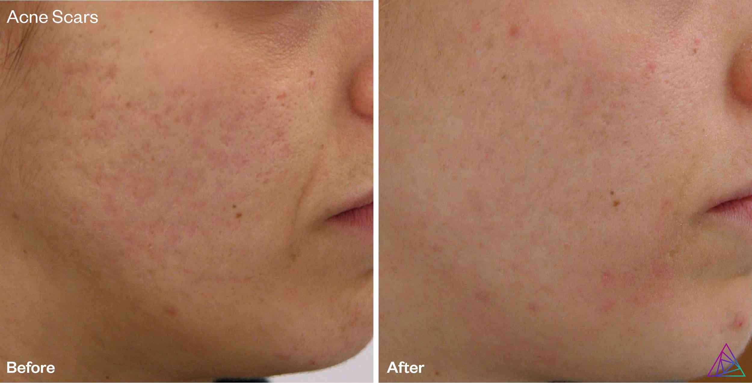 Acne Laser Machines for Clinics & Med Spas | Professional Systems